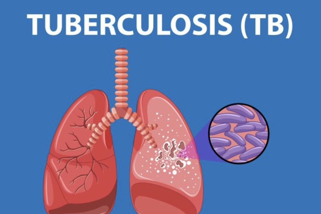Mengenal Tuberkulosis (TBC): Gejala, Penyebab, dan Penanganannya